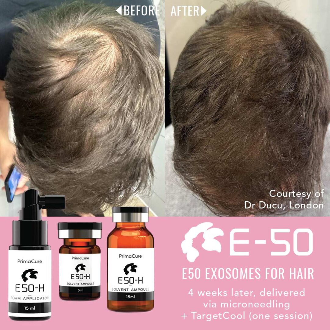 E50 Exosomes Treatment Stockport | The Clinic Cheshire